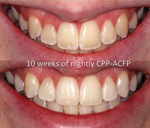 Enhanced Minimal Invasive Tooth Whitening - Oral Health Group