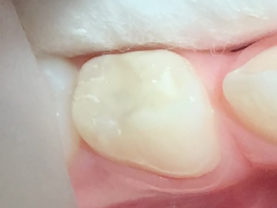 Clinical Uses for Silver Diamine Fluoride - Oral Health Group