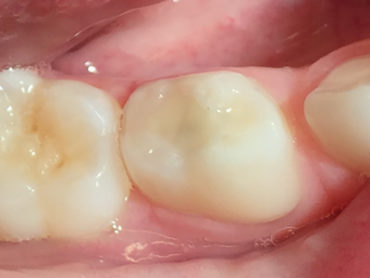 Clinical Uses for Silver Diamine Fluoride - Oral Health Group