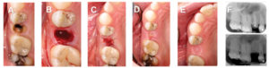 Post-Extraction Socket and Ridge Preservation - Oral Health Group