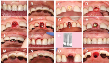 Post-Extraction Socket and Ridge Preservation - Oral Health Group