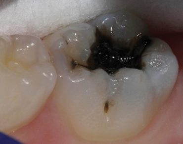 Paediatric Restorative Materials for Your 21st Century General Practice