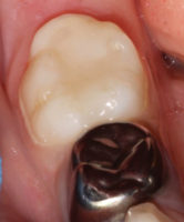 Paediatric Restorative Materials for Your 21st Century General Practice