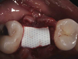 Biomechanical Implant Failures Management Of An Implant Failure