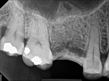 Biomechanical Implant Failures Management Of An Implant Failure
