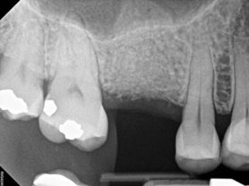 Shieh Fig 24 Homogenous trabecular pattern of the socket preserved site ...