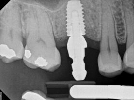 Biomechanical Implant Failures Management Of An Implant Failure