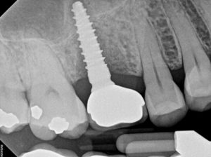 Biomechanical Implant Failures Management Of An Implant Failure
