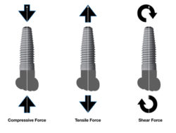 Biomechanical Implant Failures Management Of An Implant Failure