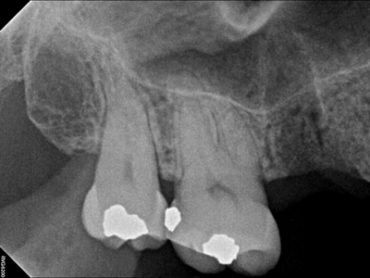 Biomechanical Implant Failures Management Of An Implant Failure