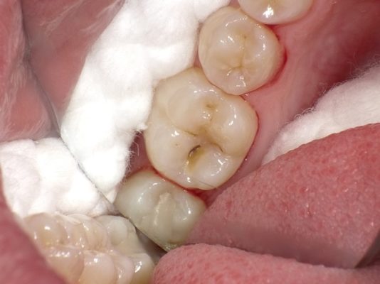 Bioactive Giomer Materials Can Help Improve Clinical Outcomes - Oral ...