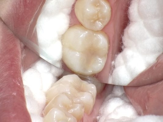 Bioactive Giomer Materials Can Help Improve Clinical Outcomes - Oral ...