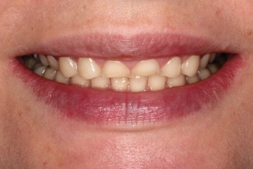 Minimally Invasive Smile Rejuvenation - Oral Health Group