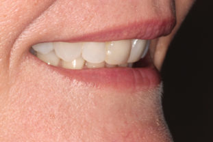 Minimally Invasive Smile Rejuvenation - Oral Health Group