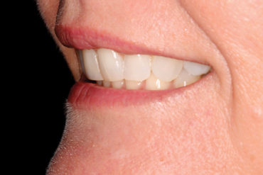 Minimally Invasive Smile Rejuvenation - Oral Health Group