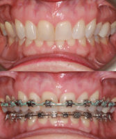 Minimally Invasive Smile Rejuvenation - Oral Health Group