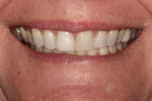 Minimally Invasive Smile Rejuvenation - Oral Health Group