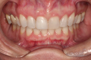 Minimally Invasive Smile Rejuvenation - Oral Health Group