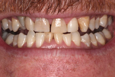 Minimally Invasive Smile Rejuvenation - Oral Health Group