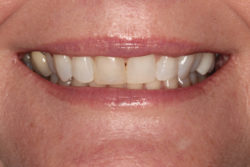 Minimally Invasive Smile Rejuvenation - Oral Health Group