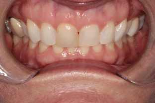 Minimally Invasive Smile Rejuvenation - Oral Health Group