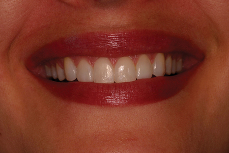 Lambert Fig 14. Final. Full smile. - Oral Health Group