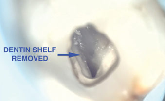 The Notorious MB2 Canal: How To Find And Treat It - Oral Health Group