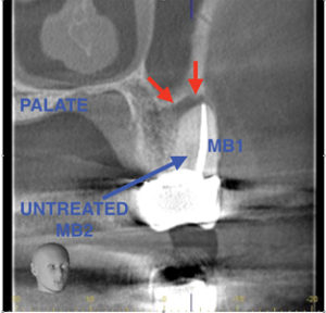 The Notorious MB2 Canal: How To Find And Treat It - Oral Health Group