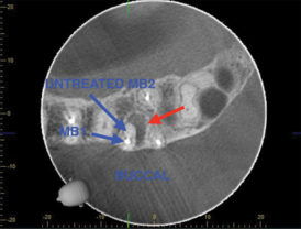 The Notorious MB2 Canal: How To Find And Treat It - Oral Health Group