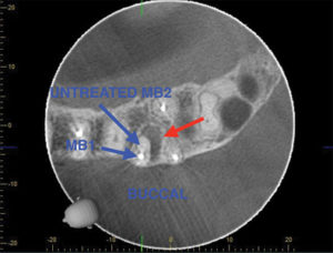 The Notorious MB2 Canal: How To Find And Treat It - Oral Health Group