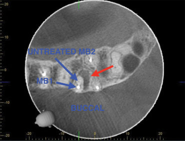 The Notorious MB2 Canal: How To Find And Treat It - Oral Health Group