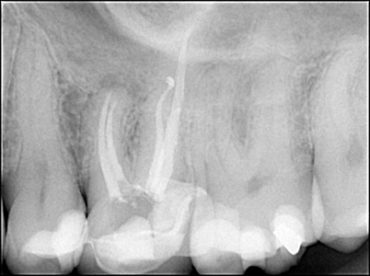 The Notorious MB2 Canal: How To Find And Treat It - Oral Health Group