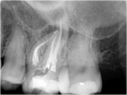 The Notorious MB2 Canal: How To Find And Treat It - Oral Health Group