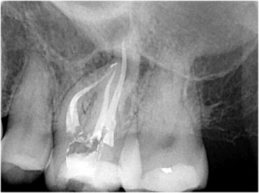 The Notorious MB2 Canal: How To Find And Treat It - Oral Health Group