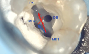 The Notorious MB2 Canal: How To Find And Treat It - Oral Health Group
