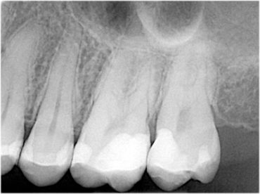 The Notorious MB2 Canal: How To Find And Treat It - Oral Health Group