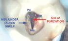 The Notorious MB2 Canal: How To Find And Treat It - Oral Health Group