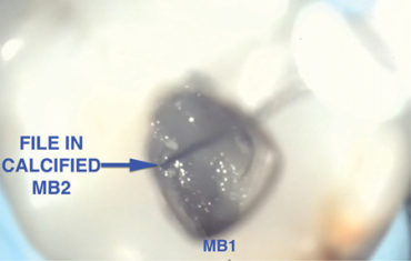 The Notorious MB2 Canal: How To Find And Treat It - Oral Health Group