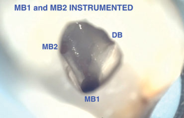 The Notorious MB2 Canal: How To Find And Treat It - Oral Health Group