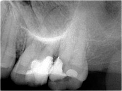 The Notorious MB2 Canal: How To Find And Treat It - Oral Health Group