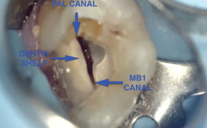The Notorious MB2 Canal: How To Find And Treat It - Oral Health Group