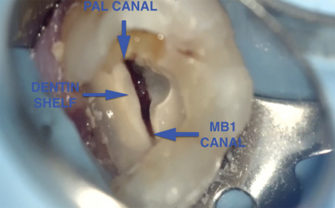 The Notorious MB2 Canal: How To Find And Treat It - Oral Health Group