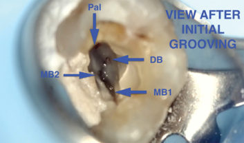 The Notorious MB2 Canal: How To Find And Treat It - Oral Health Group