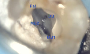 The Notorious MB2 Canal: How To Find And Treat It - Oral Health Group