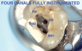 The Notorious MB2 Canal: How To Find And Treat It - Oral Health Group