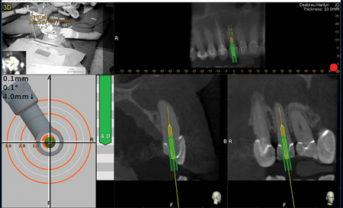 Dynamic Endodontic Navigation: A Case Report - Oral Health Group