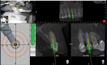 Dynamic Endodontic Navigation: A Case Report - Oral Health Group
