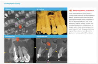 Dynamic Endodontic Navigation: A Case Report - Oral Health Group