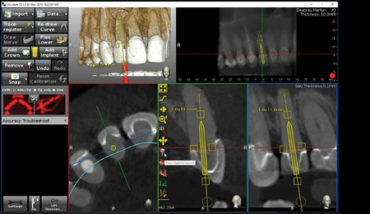 Dynamic Endodontic Navigation: A Case Report - Oral Health Group