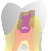 The Endodontic Restorative Harmonic: Part I Access To Apex, Apex To ...